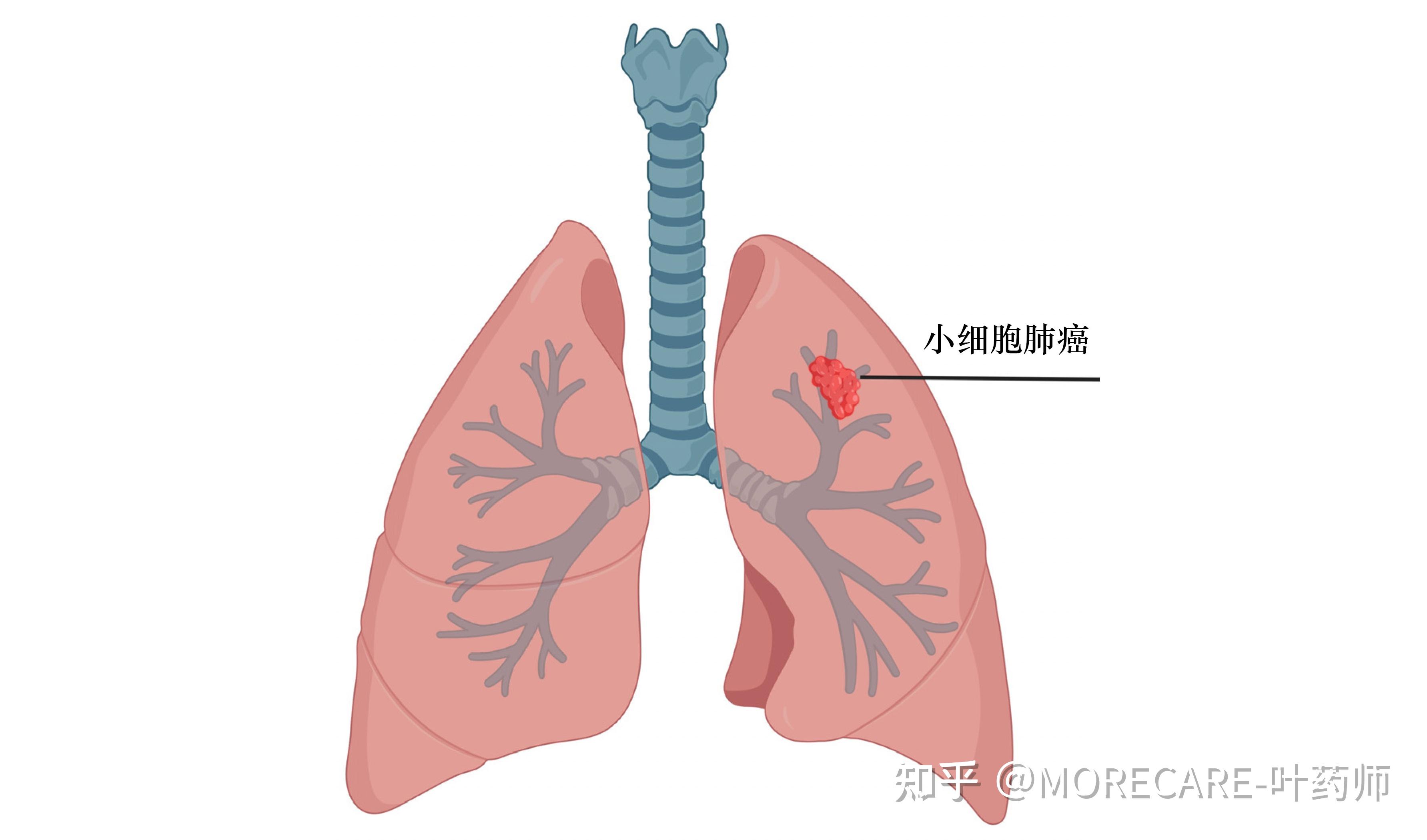 3期试验：IMDELLTRA可显著改善小细胞肺癌患者总生存期 - 知乎