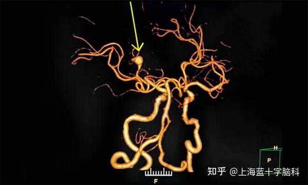 脑血管病做什么检查？专家解读：CTA、MRA、DSA - 知乎