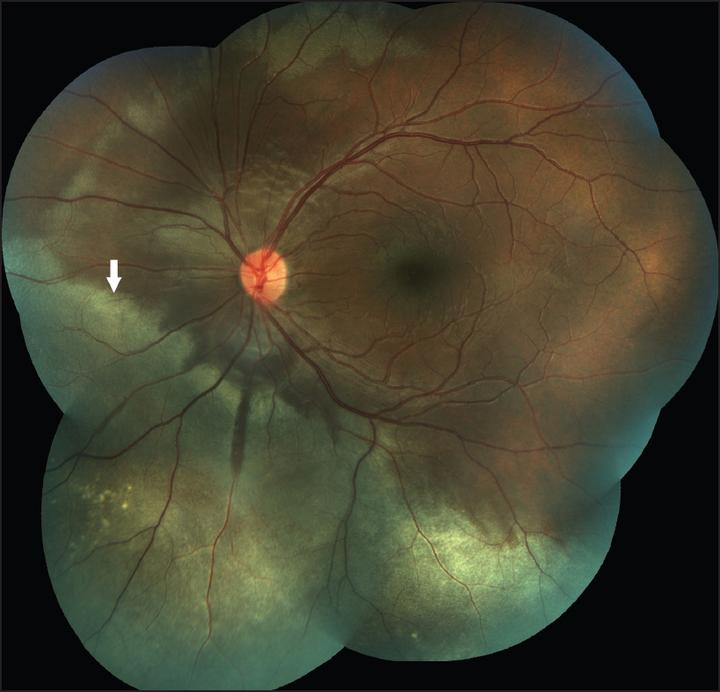 与外伤相关的视网膜病变——1、视网膜震荡 - 知乎