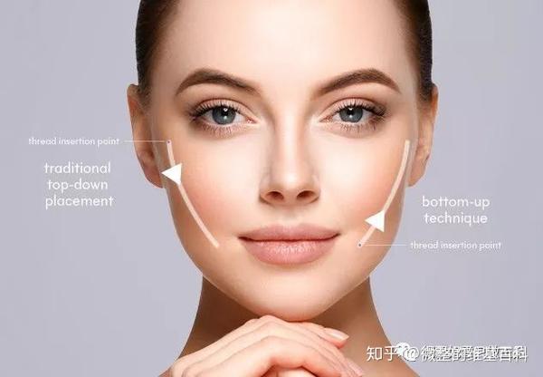 今天我们来聊聊线雕吧，你们只知道PDO/PPDO和PLA以及PLLA吗？史上最全线雕科普包含铃铛线 - 知乎