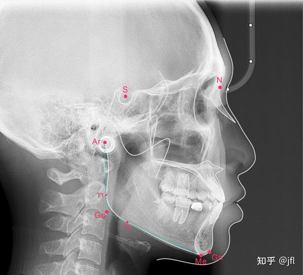 Jarabak 分析法 - 知乎