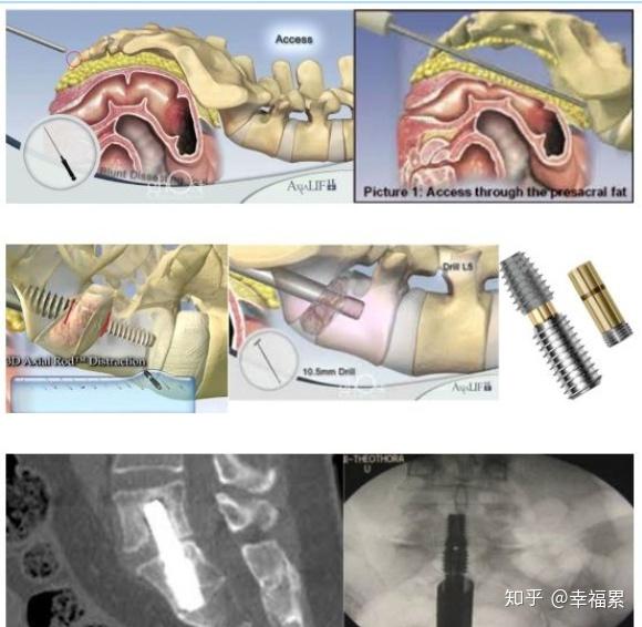 UBE 这些差别你知道吗？PLF PLIF TLIF DLIF XLIF 手术技术对比【医术苑】科普 - 知乎