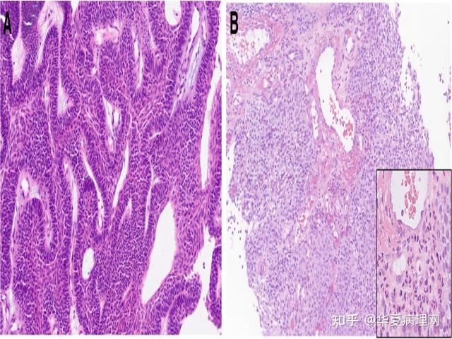 分子定义的鼻腔鼻窦恶性肿瘤-上皮部分简明版（一） - 知乎
