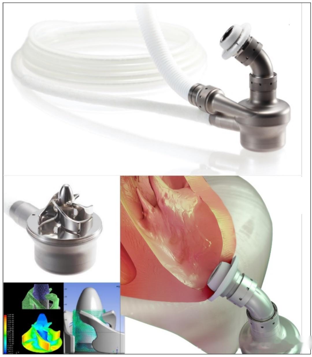 医生专栏 | 下一代人工心脏 - 知乎