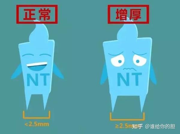 NT检查到底查什么？ - 知乎