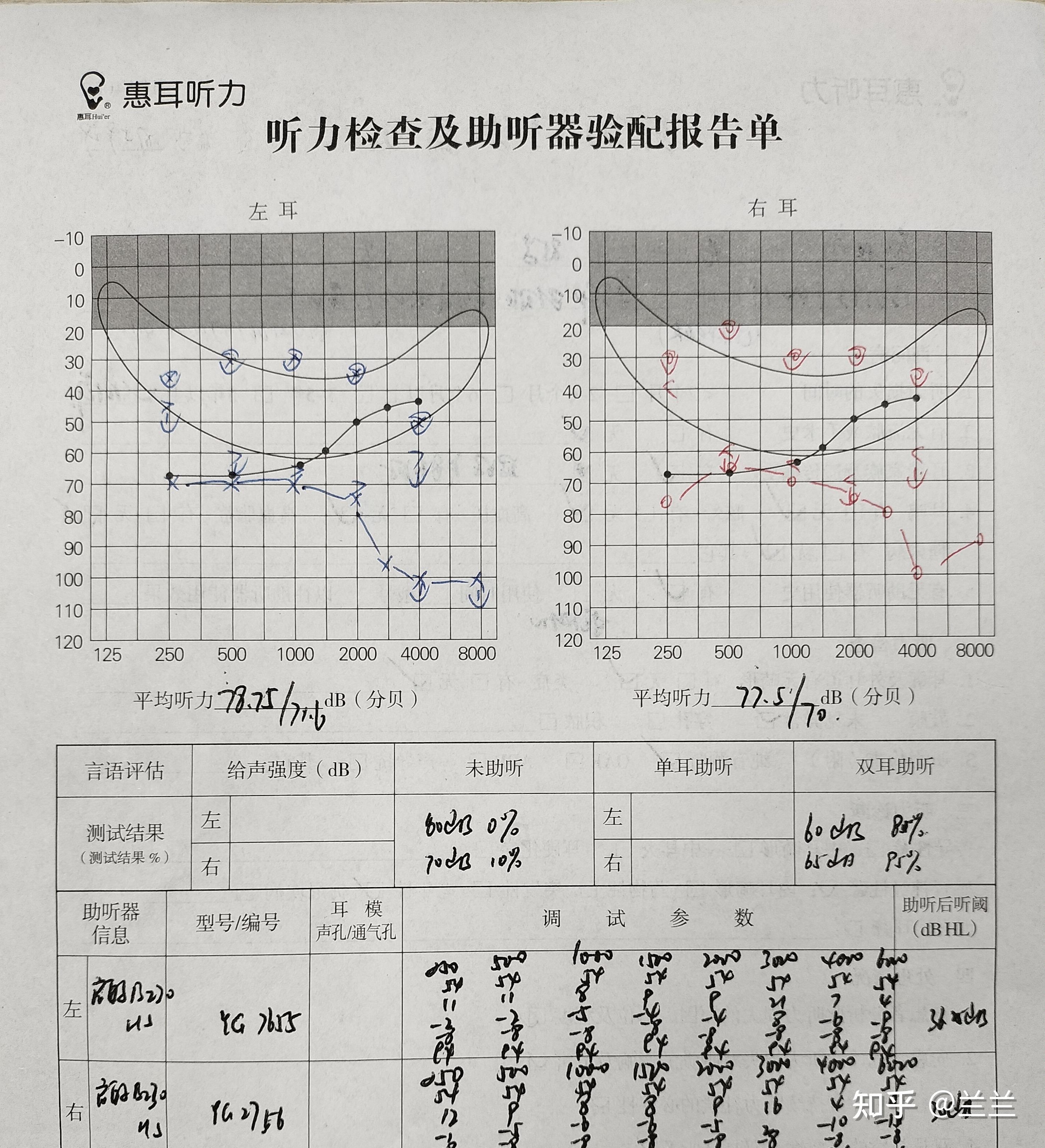 永川惠耳听力分享:言语分辨率较差的验配助听器案例 知乎