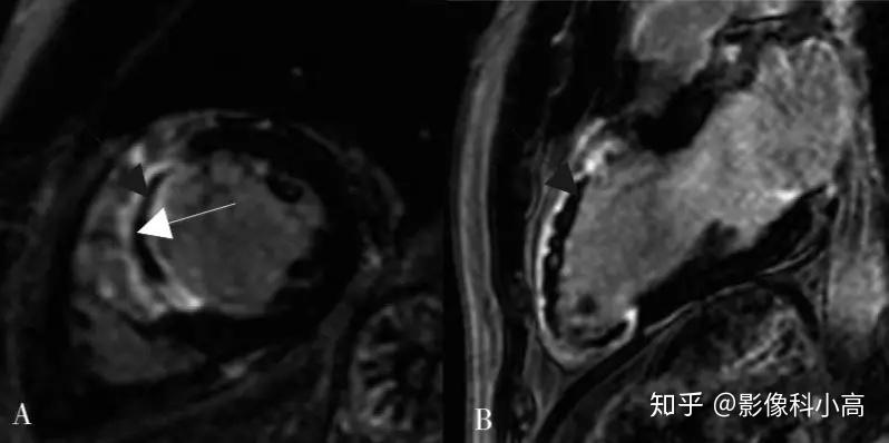 科普|CMR-心梗后微循环障碍 - 知乎