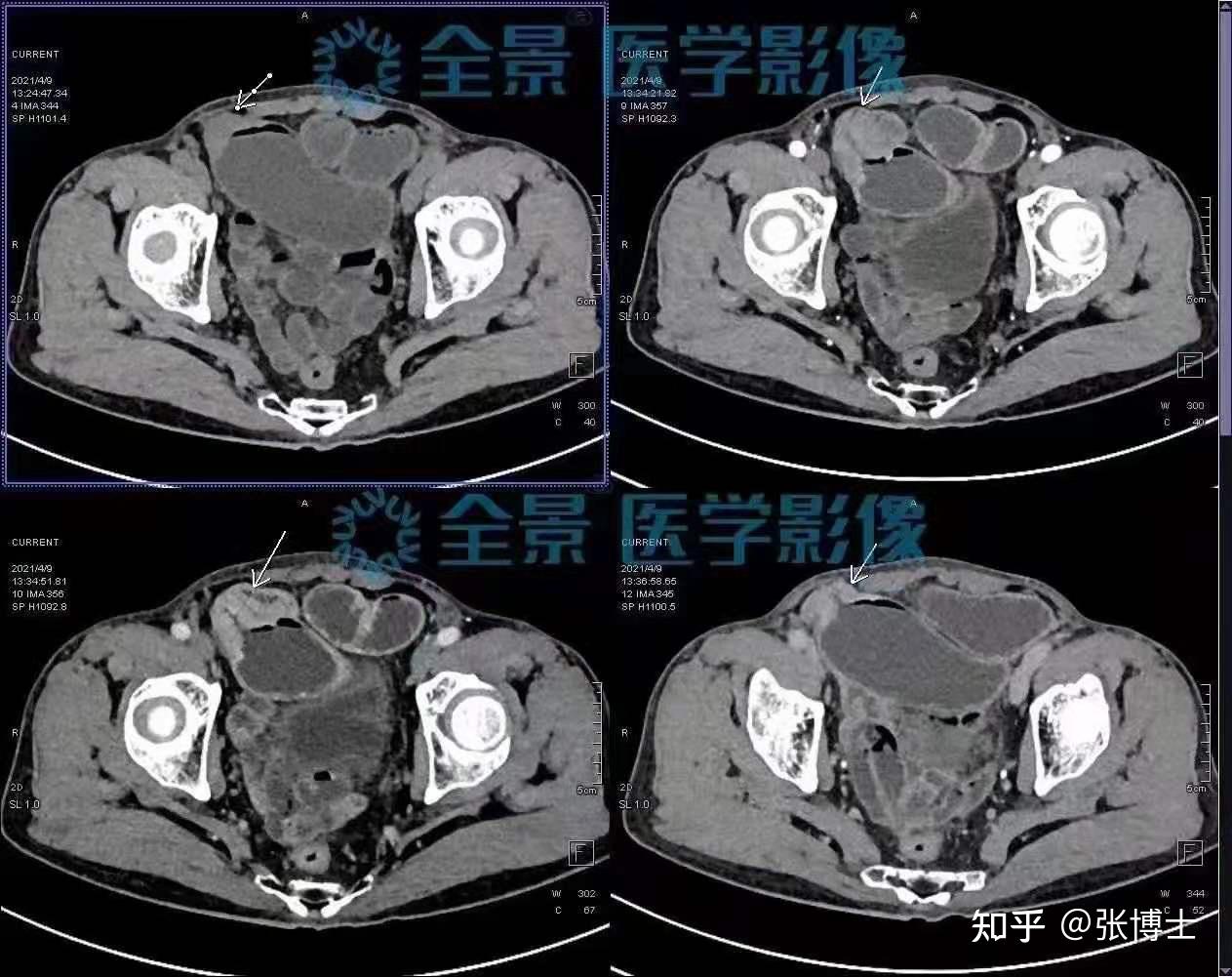 全景医学影像小肠增强CT三维重建案例分享 - 知乎
