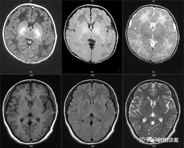 这些MRI知识，秘密？常识？ - 知乎