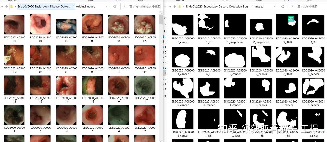 如何使用TransUNet、UNet、DeepLabV3+、HRNet、PSPNet 模型对息肉分割数据集进行训练、评估和可视化 EDD2020息肉数据集分割数据集 息肉数据集 - 知乎
