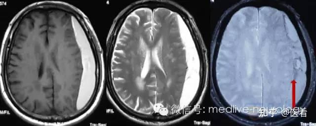 脑出血CT、MRI之争的终结者：GRE序列（T2*&SWI） - 知乎
