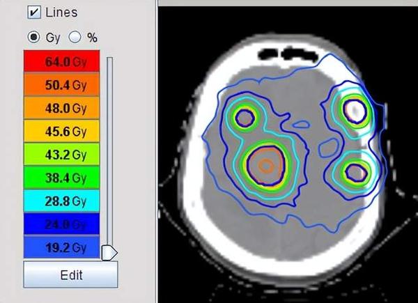 100万脑转移瘤救星【HyperArc超弧刀】——无创治疗颅内肿瘤 - 知乎