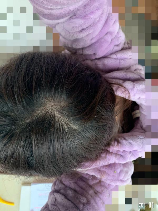 头皮毛囊炎脱发怎么办?掉的头发还能长出来吗? 知乎