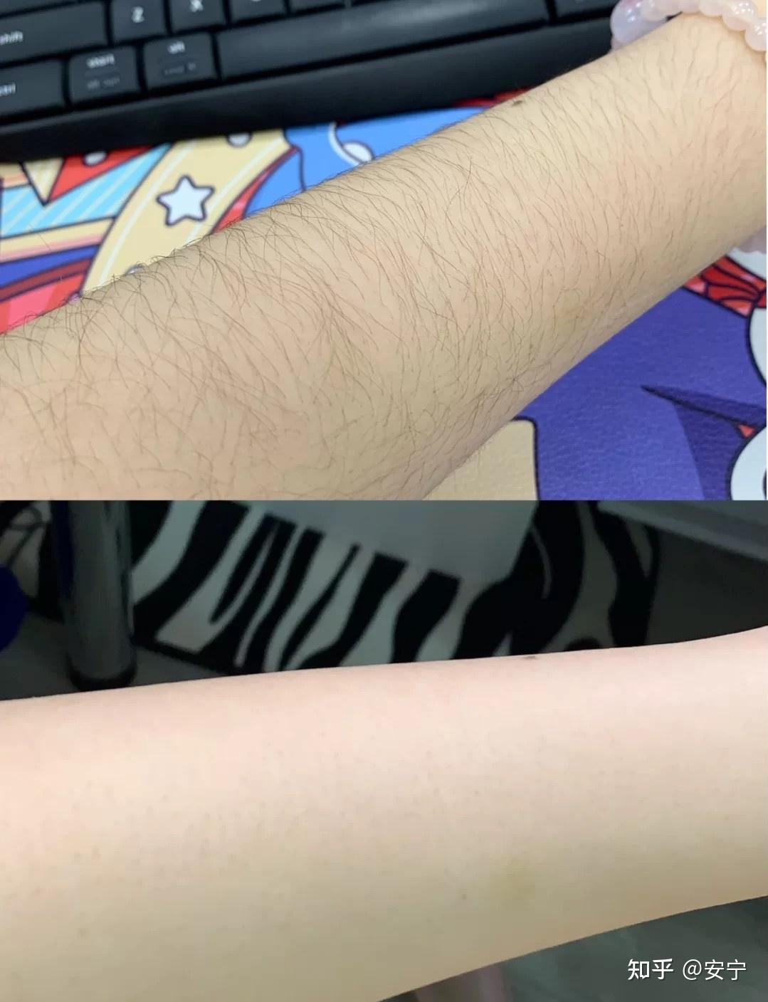 网上炒疯的八大脱毛仪品牌，到底哪款最值得买？（Ulike、BeautiGo、Amiro、慕金、易美肌、博朗、飞利浦、小猫安妮） - 知乎