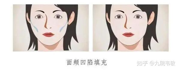 九院韦敏说,面部凹陷为什么会显老?如何改善 知乎