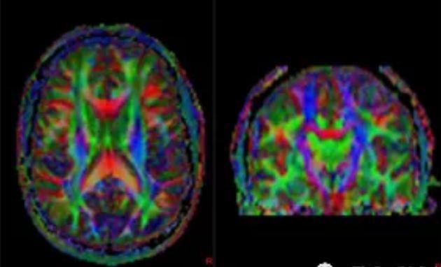 DTI技术原理及临床应用 - 知乎