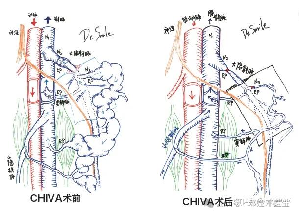 干货！一文了解静脉曲张CHIVA治疗的原理和优缺点 - 知乎