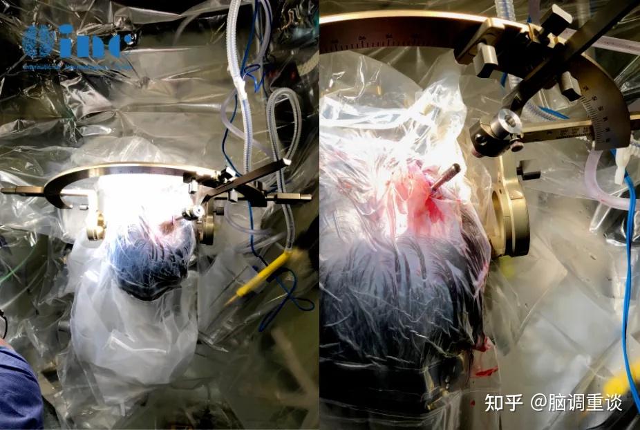 儿童癫痫＆脑瘤治疗新选择：INC（爱恩希）Rutka教授LITT治疗技术真实案例分享！ - 知乎