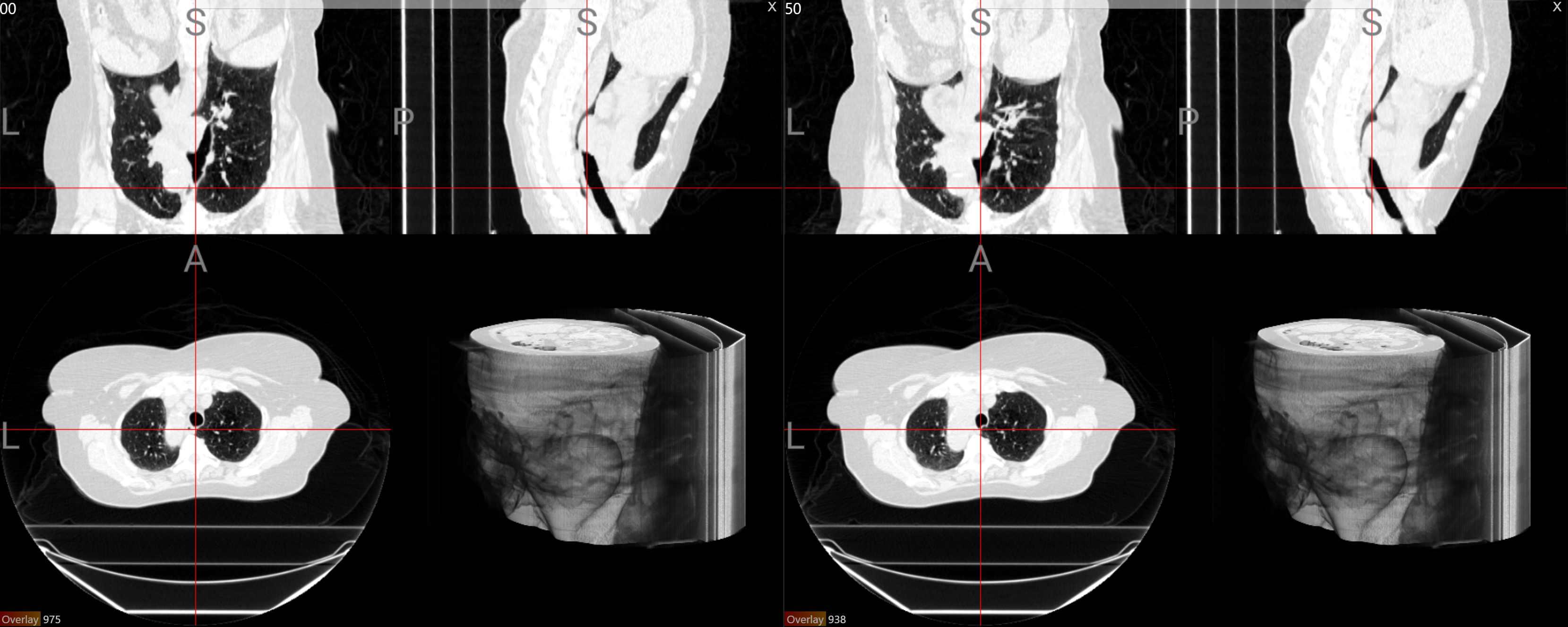 使用 voxelmorph 进行 CT 影像配准——原理和代码实现 - 知乎