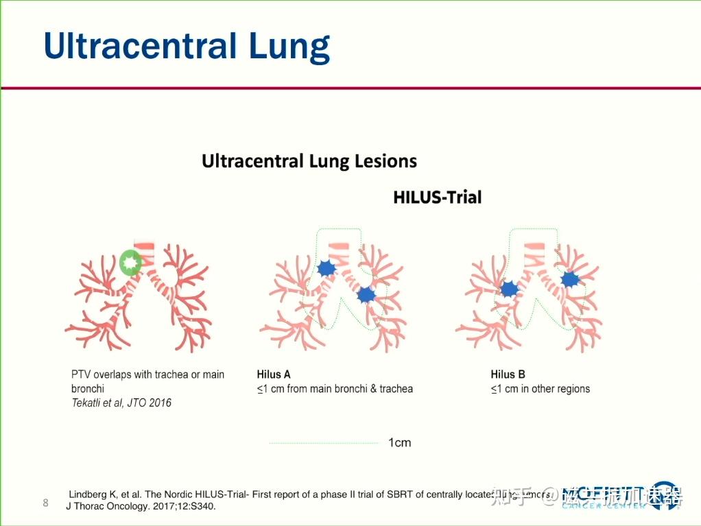 “穿针引线”-磁共振引导的中央、超中央型肺癌放射消融治疗 - ViewRay MRIdian - 知乎