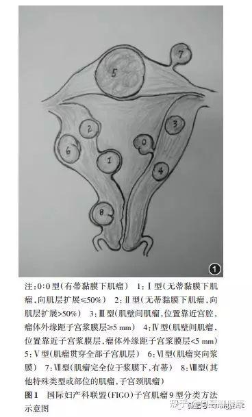子宫肌瘤详细分类 - 知乎