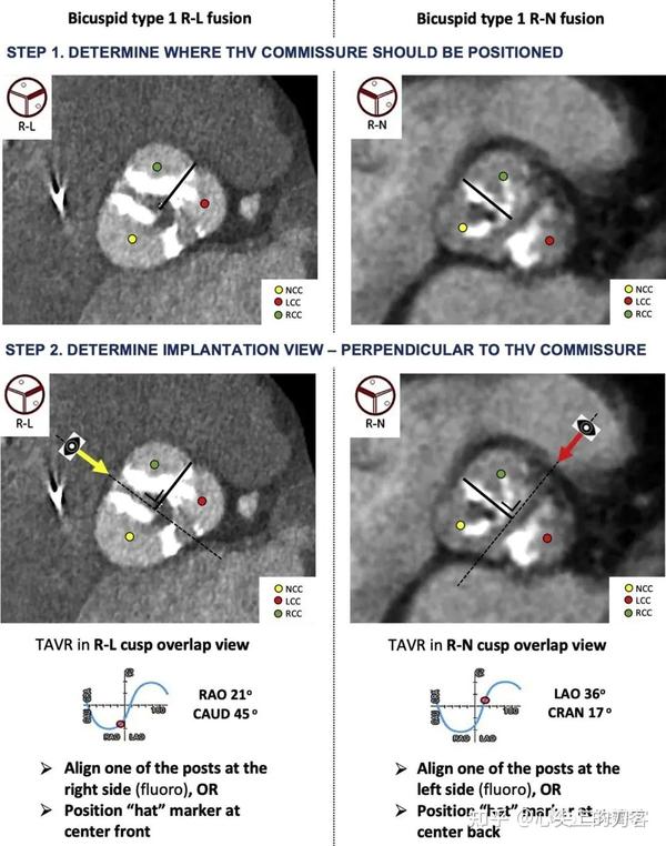 连合对齐（Commissural Alignment）：原理、定义、技术和结果（下） - 知乎