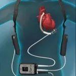 循证丨左心室辅助装置（LVAD）的研究进展 - 知乎