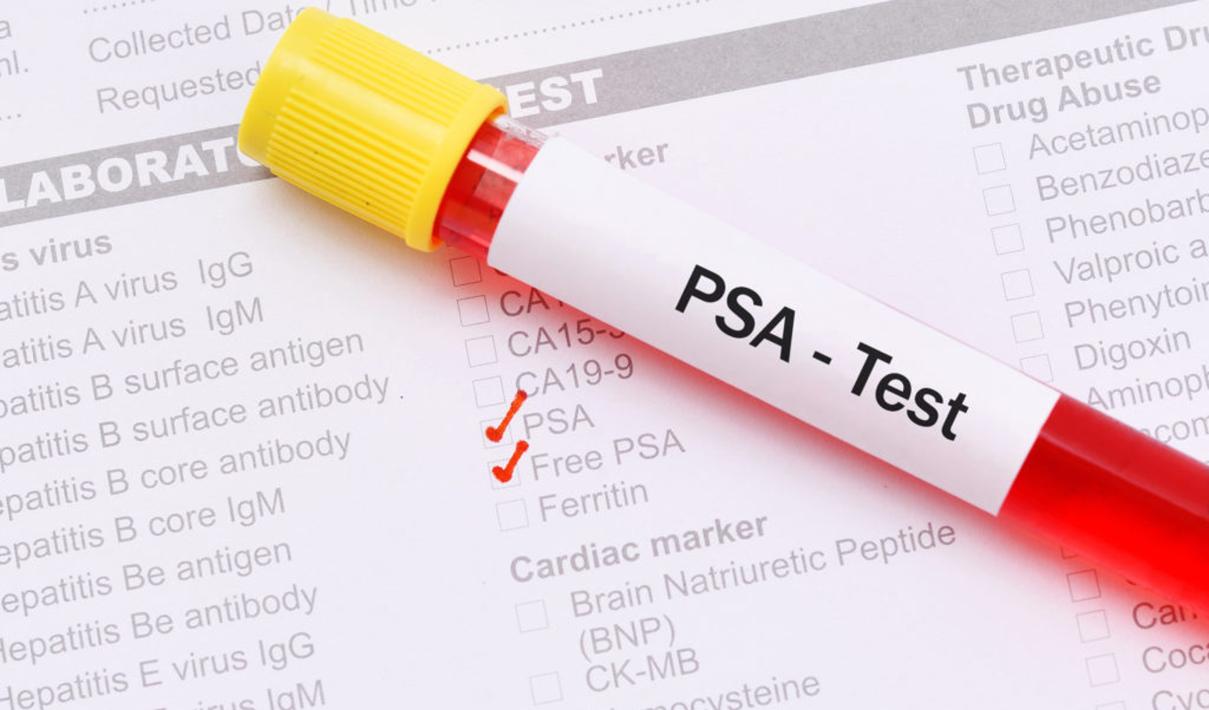 读懂化验单上的肿瘤标志物，PSA值与前列腺癌的那些事 - 知乎