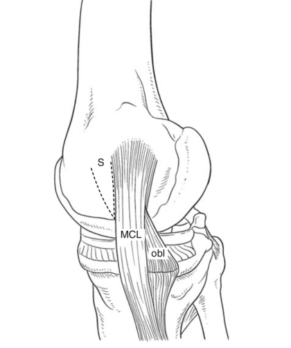 膝关节内侧副韧带（MCL）磁共振解剖要点 - 知乎