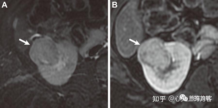 结节性硬化症丨诊断标准、影像表现、临床监测与治疗 - 知乎