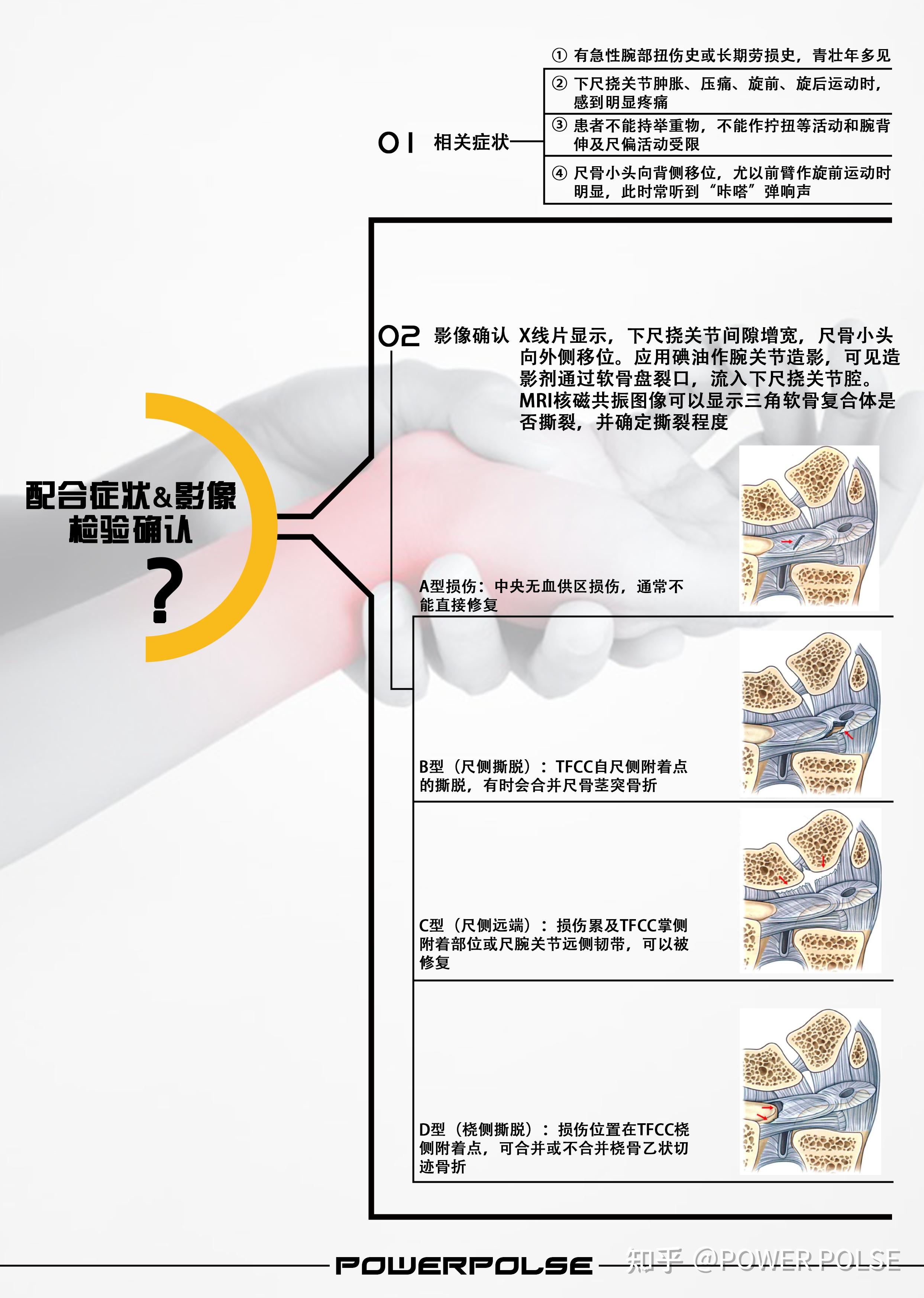 手腕TFCC损伤全攻略，跟着思维导图逐步康复！ - 知乎