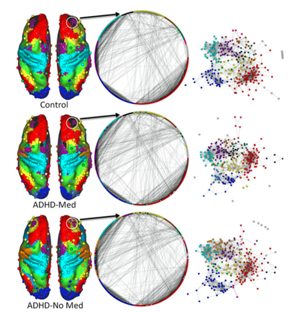 如何改善多动症ADHD异常的脑神经网络属性？ - 知乎
