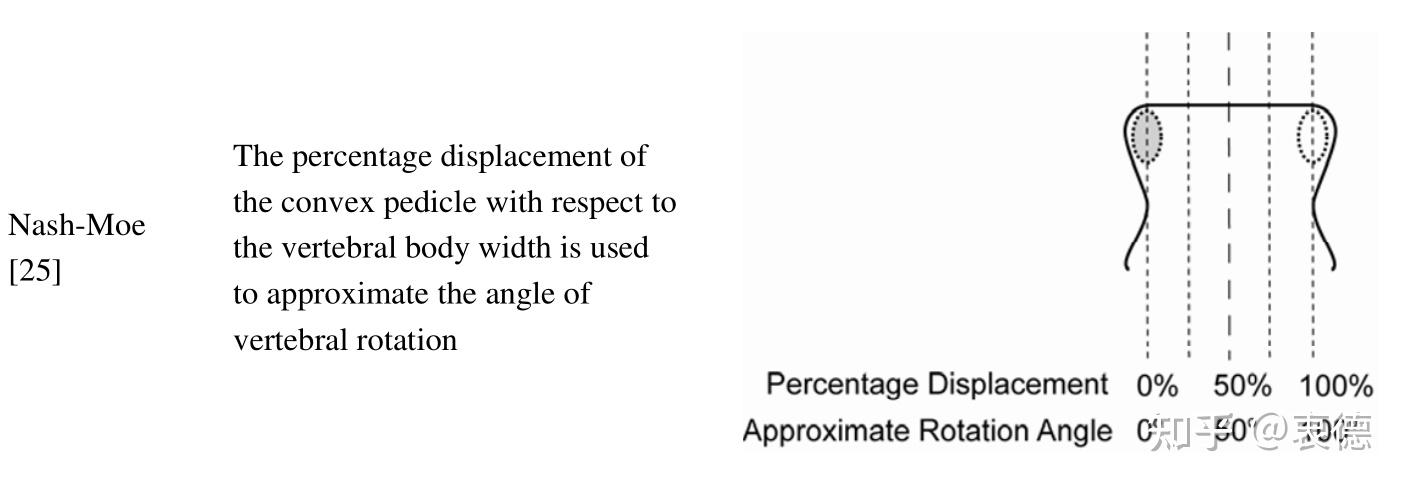 为什么侧弯好转，脊椎旋转（弯腰一边隆起）却没变化？ - 知乎