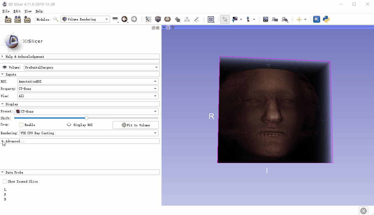 3D Slicer——选择感兴趣区，输出为DICOM序列 - 知乎