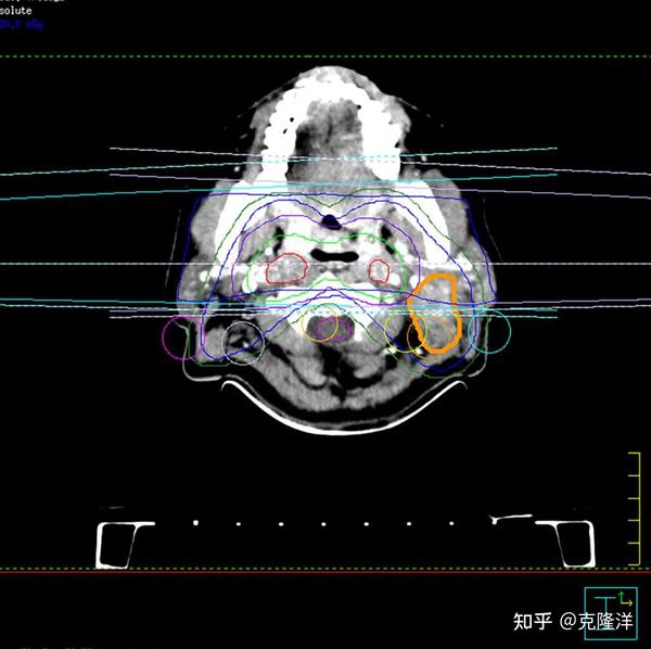 DC-CIK细胞治疗鼻咽癌肺纵隔转移患者-13年无复发无转移 - 知乎