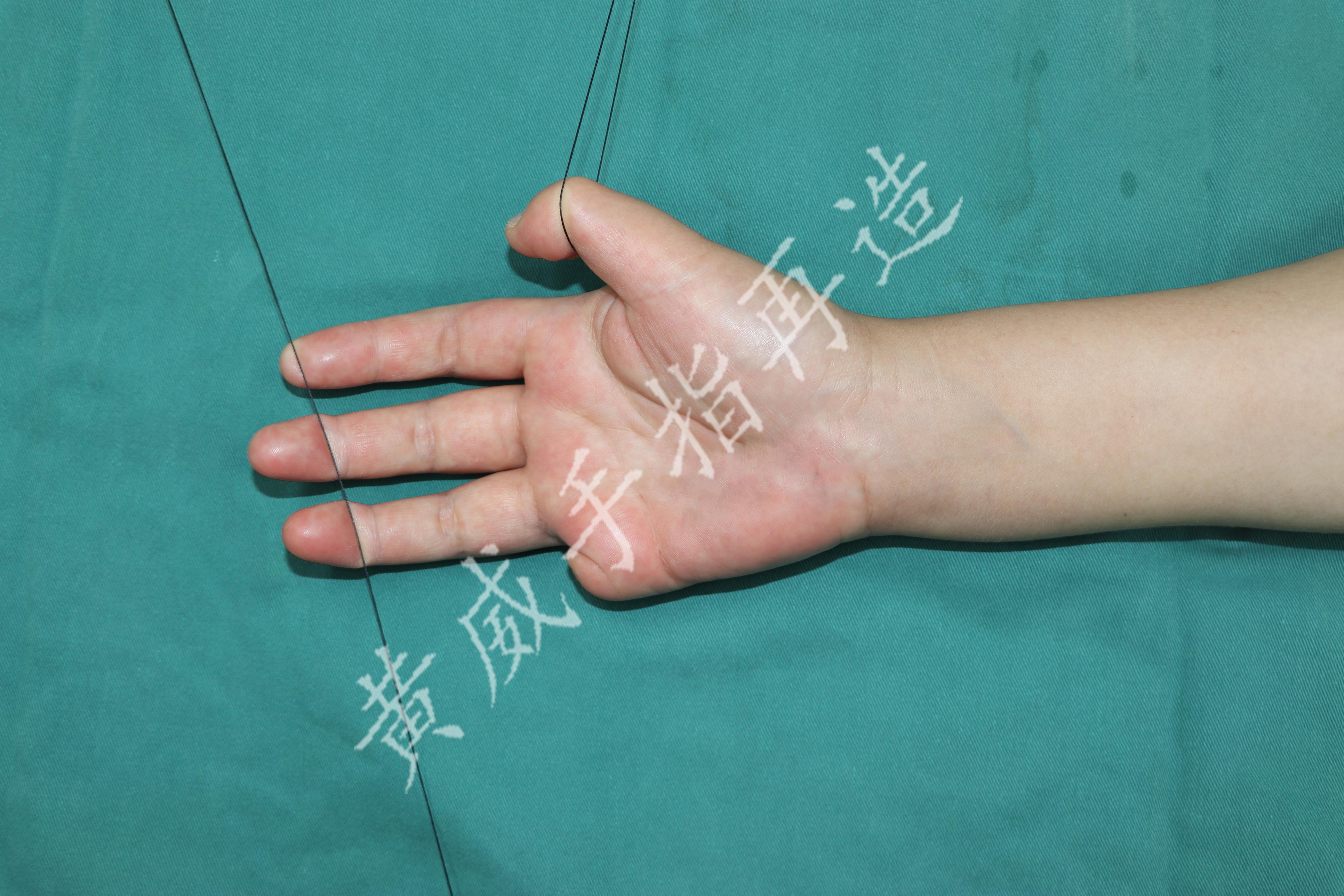 手指骨裂后如何进行康复训练？ - 知乎