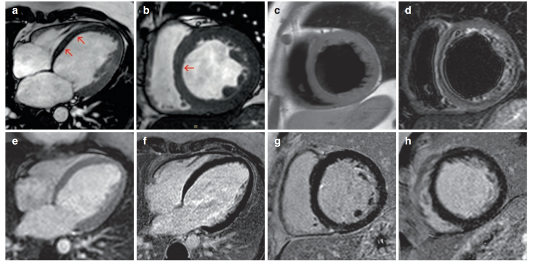 心脏磁共振典型病例集锦 - 知乎