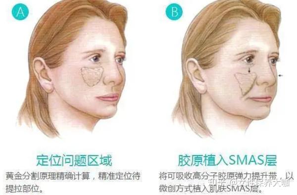 揭秘：微拉美面部提升术的真相、微拉美面部提升后遗症没几人知道！ - 知乎