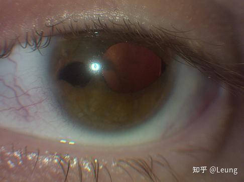 Axenfeld Rieger 综合征综述 - 知乎