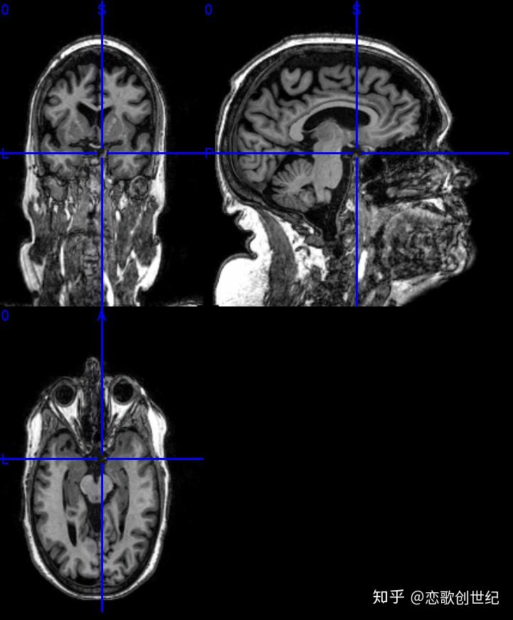基于SPM的磁共振图像(MRI)手动ACPC矫正 - 知乎