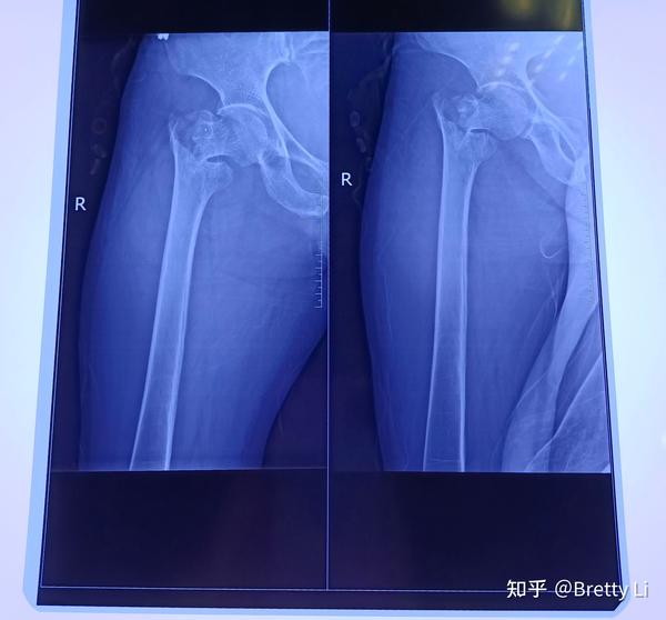 常见骨折类型X线片–探讨分析2 - 知乎