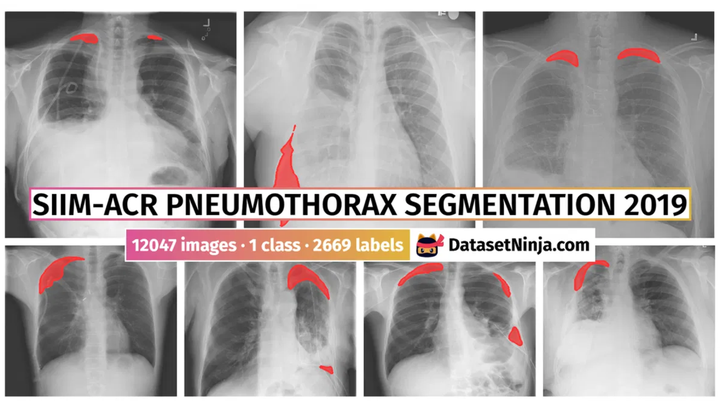 Pneumothorax Masks X-Ray 数据集介绍 - 知乎