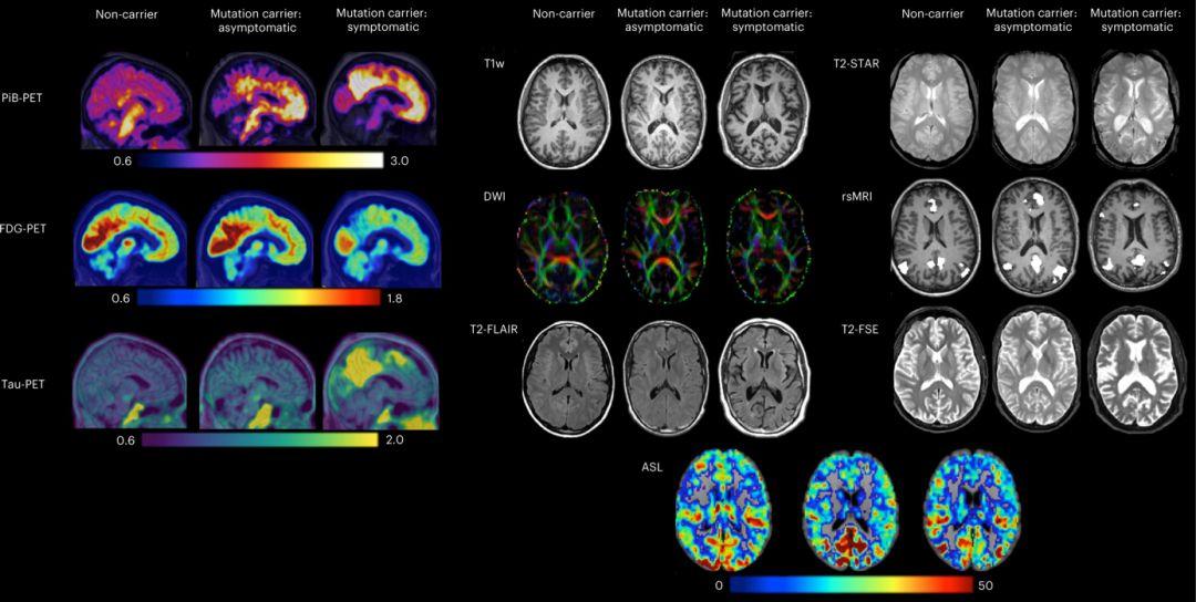 Nat子刊: 一类特殊AD的珍贵神经影像资源（PET/MRI数据集） - 知乎