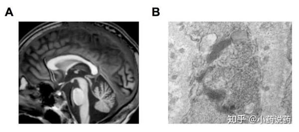 小药说药药物篇-为一个人研发的药物：“Milasen” - 知乎