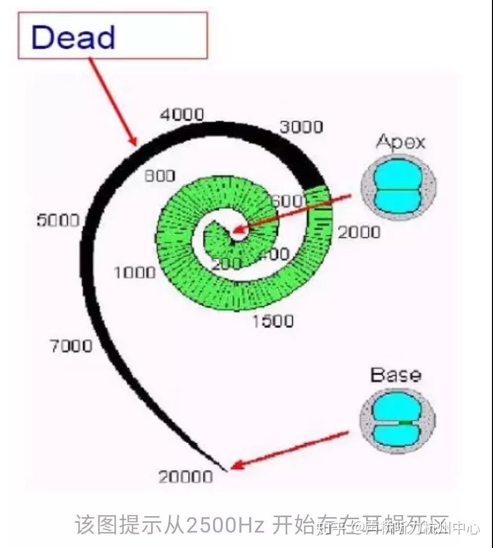 揭开耳蜗死区的神秘面纱 - 知乎