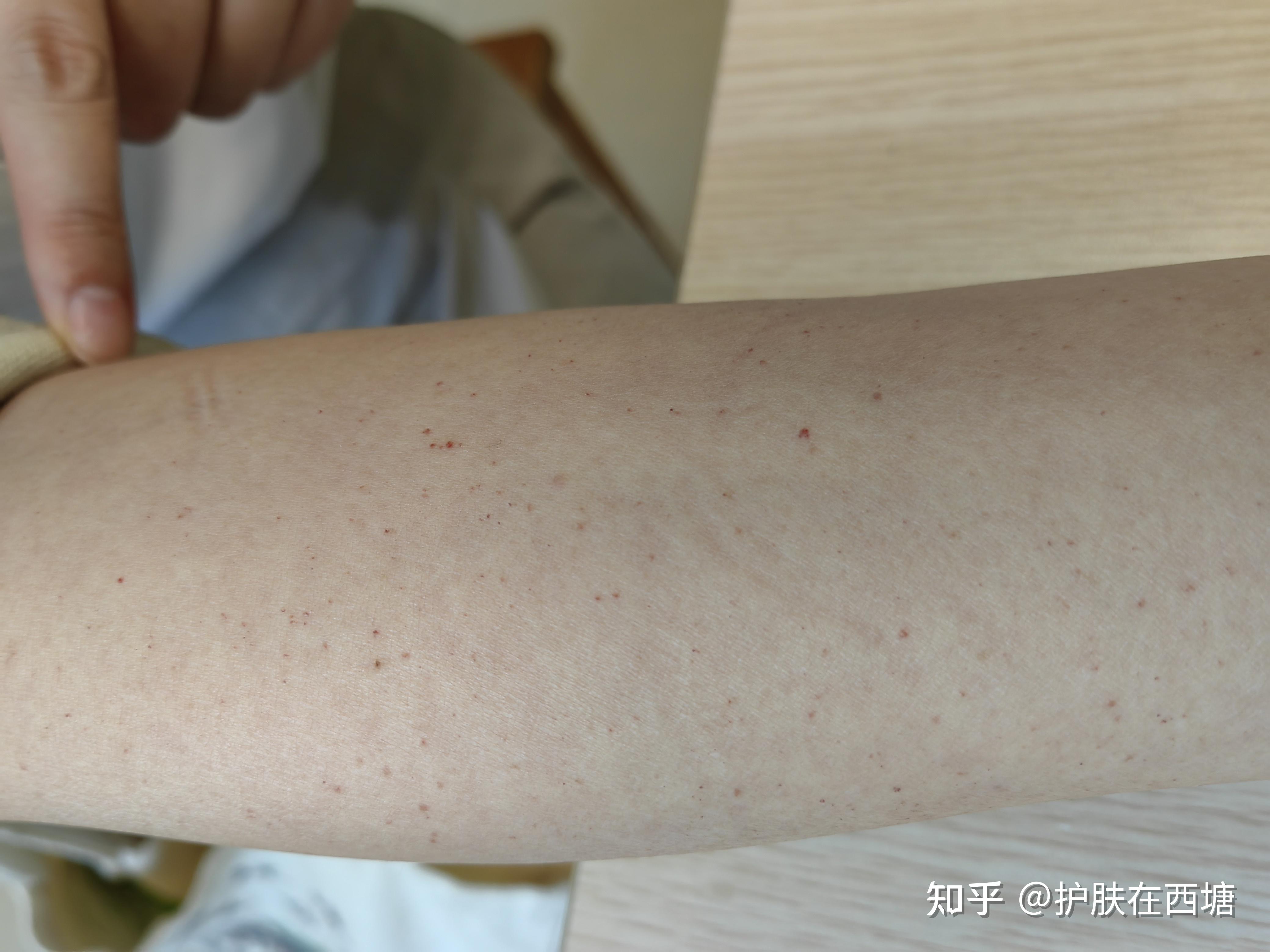 胳膊上的红点点，究竟怎么来的？ 知乎 1688