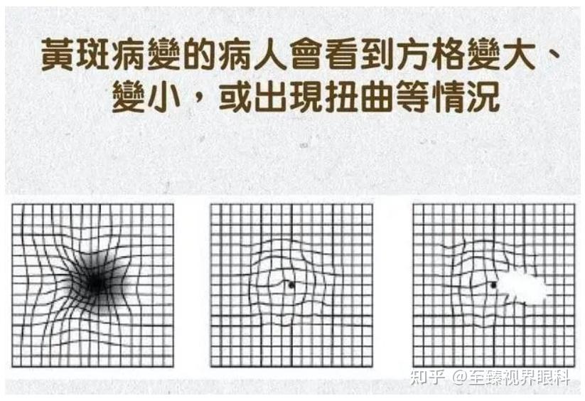 阿姆斯勒表自测黄斑病变的方法 - 知乎