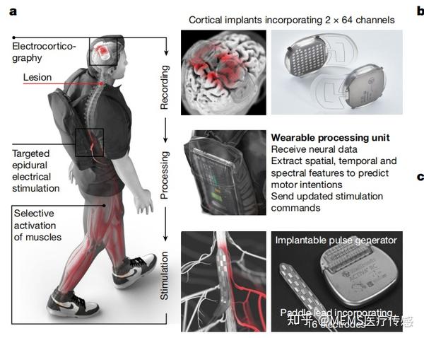 脑机接口之ECoG电极（一） - 知乎