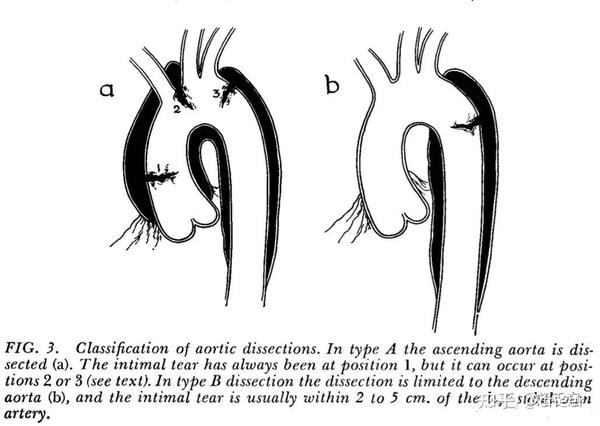 对主动脉夹层分型的一点疑惑及答案 - 知乎