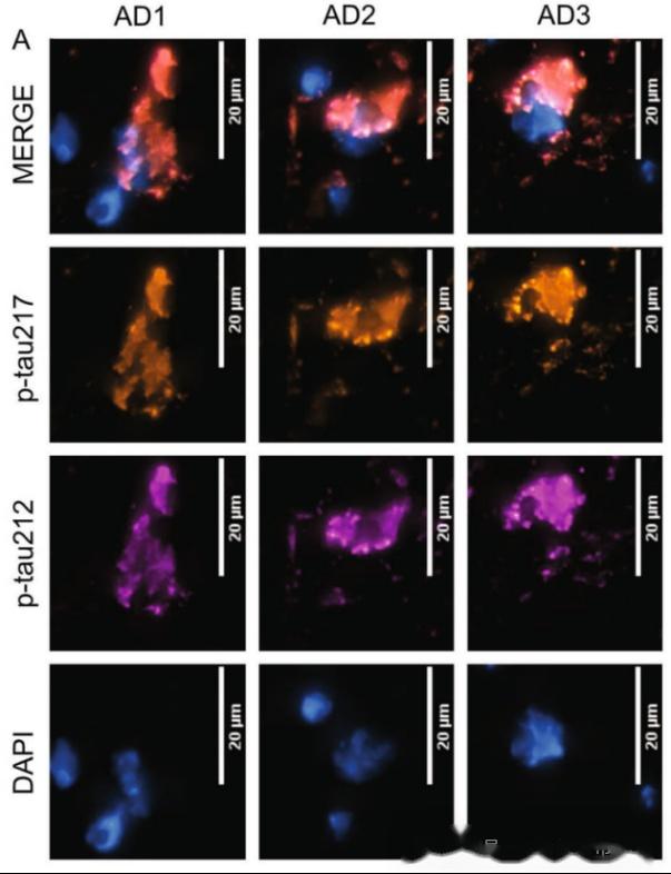 Simoa HD-X （ Quanterix）上开发了p-tau212阿尔茨海默病诊断试剂 - 知乎